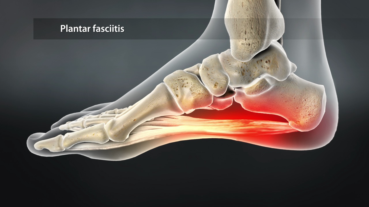Penderita Plantar Fasciitis Sebaiknya Mengonsumsi Makanan Ini - Fisiohome