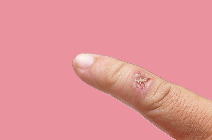 Fisioterapi Daerah Surabaya untuk Penderita Skleroderma | Fisiohome